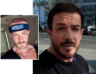 Simon Teichmann: imágenes antes, después - 3500 Grafts | Elithair